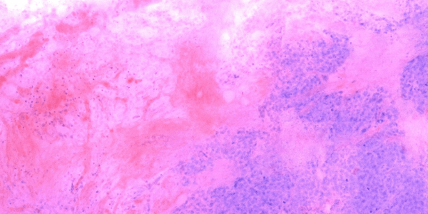 H&E Staining and Cancer